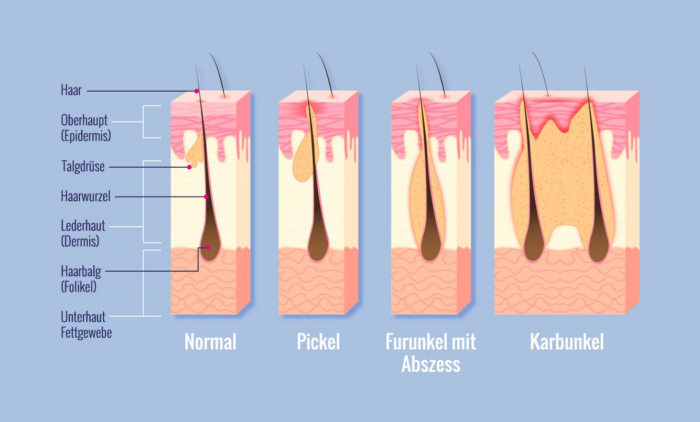 Kenali Jenis Bisul yang Membahayakan